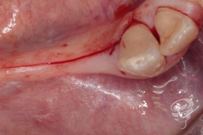 Caso clínico | Regeneración ósea - Galimplant