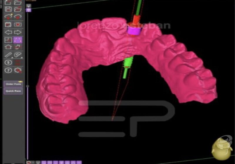 Caso clínico | Restauración de función y estética mediante cirugía guiada - Galimplant