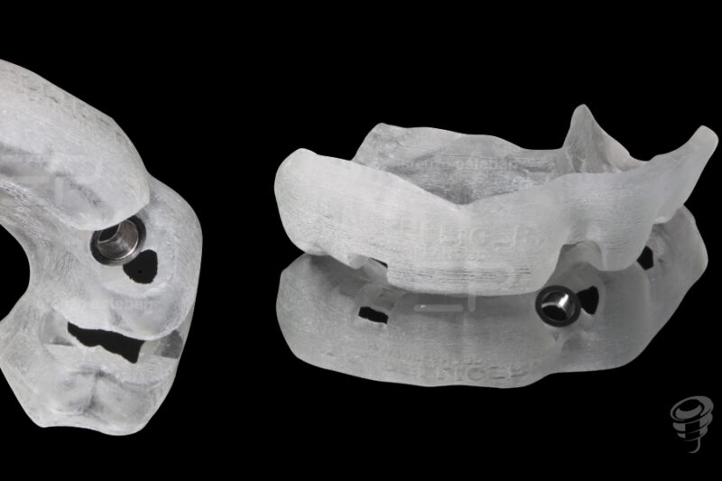 Caso clínico | Restauración de función y estética mediante cirugía ...